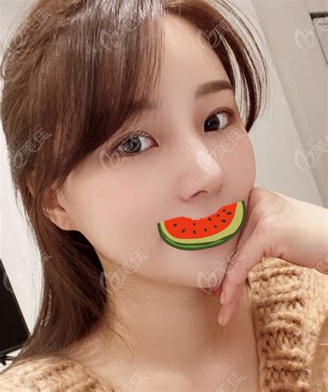 韩国做肋骨隆鼻三个月的变化图分享恢复后山根高了鼻头也缩小了 美佳网