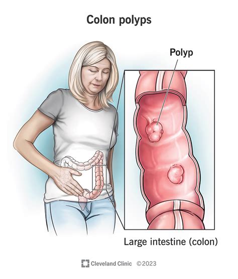 Colon Polyp Size And Type Charts 52 Off