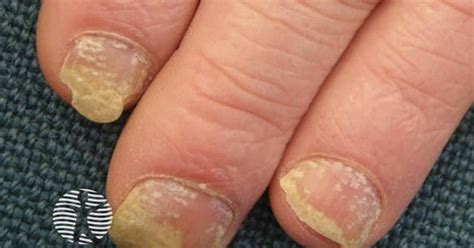 Nails In Psoriasis Image