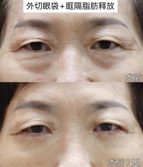外切眼袋眶隔脂肪案例分享 知乎