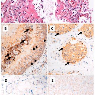 A Lung Tissue Standard Histology Diffuse Alveolar Damages With Download Scientific Diagram