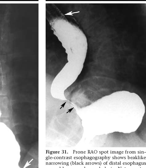 Figure 26 From Diseases Of The Esophagus Diagnosis With Esophagography