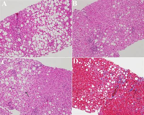 A Steatosis Of The Liver Parenchyma B Lobular Inflammation Due To