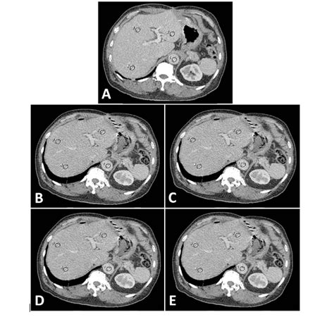 Abdominal Ct Radiation Dose Reduction At Siriraj Hospital Phase Ii The Asean Journal Of