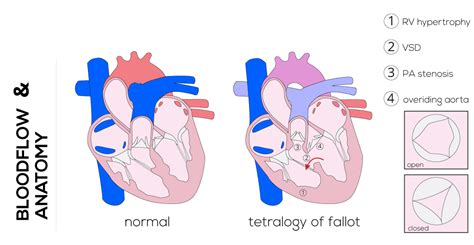 Congenital Defects Tutorial Congenital Heart Defects Atlas Of Human