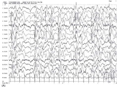 Sleep Eeg Bayarealasopa