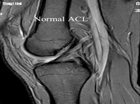 Mri Knee Acl Tear