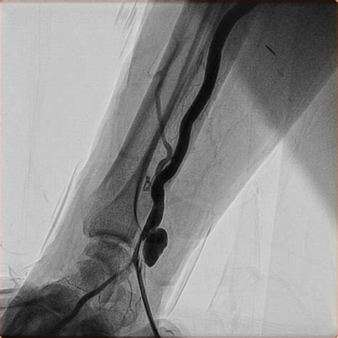 Angiography Of Radial Artery Perforation Download Scientific Diagram
