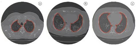 Figure 2 From Lung Disease Detection Using Feature Extraction And Extreme Learning Machine