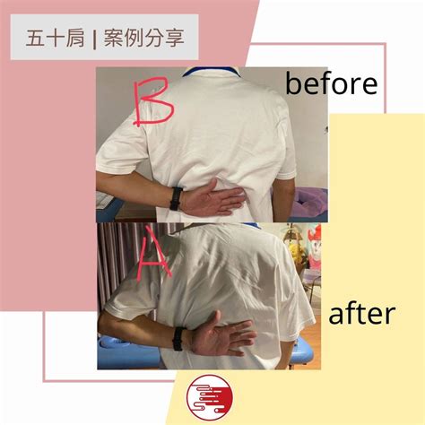 馨田徒手保健工作室 🆘拯救五十肩大作戰 常加班打電腦或是上肢使用過度的工作族群， 都有可能因勞損經常造成肩膀活動疼痛 「50肩」又稱