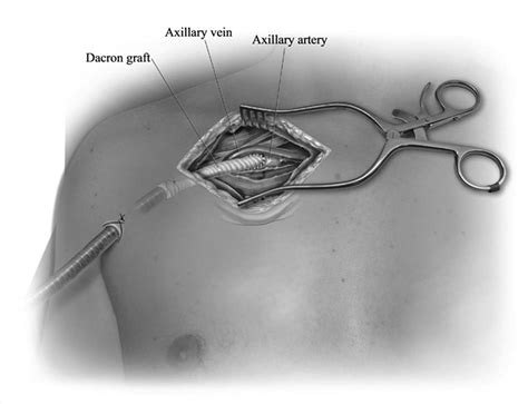 Ecmo Cannulation Techniques Intechopen