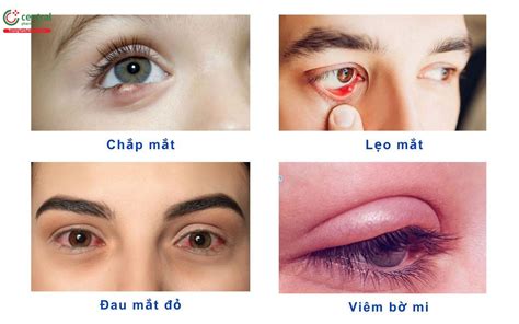 Viêm Bờ Mi Bao Lâu Thì Khỏi Nguyên Nhân Triệu Chứng Và Cách điều Trị