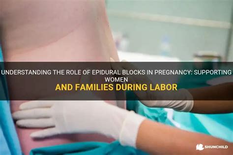 Understanding The Role Of Epidural Blocks In Pregnancy Supporting