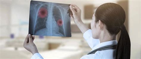 肺癌会传染吗？会遗传吗患者觅健影响