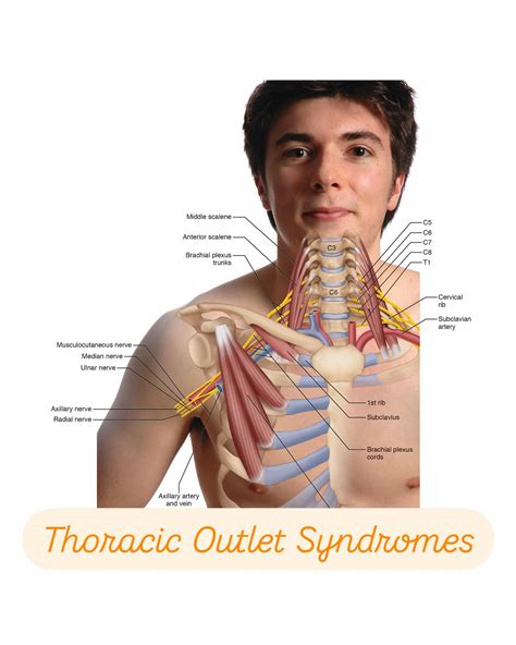 The Art There Are Four Types Of Thoracic Outlet Syndrome Tos 1