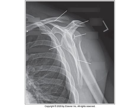 Scapular Y Diagram Diagram Quizlet