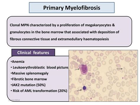Ppt Myeloproliferative Neoplasms Powerpoint Presentation Free