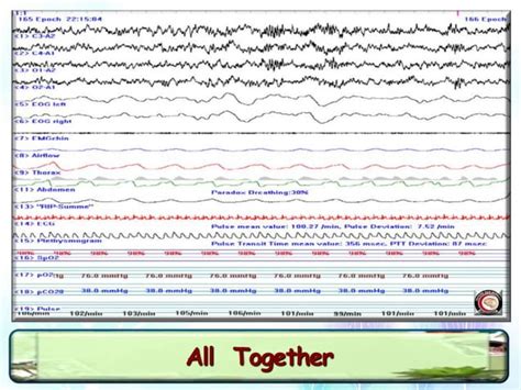 Polysomnogram Interpretetion Pptx
