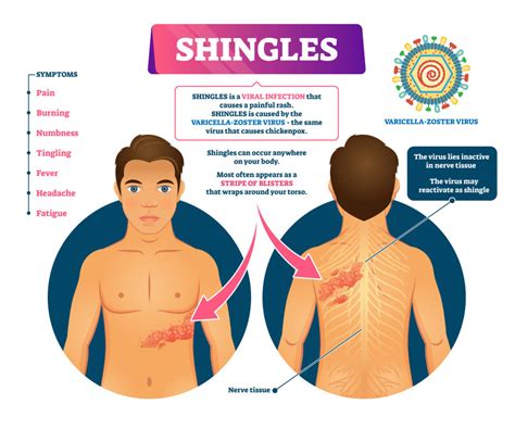 Shingles Signs And Symptoms You Need To Know How To Tell If You Have