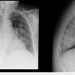 Chest X Ray Showing Bilateral Air Space Disease With Heterogenous Download Scientific Diagram