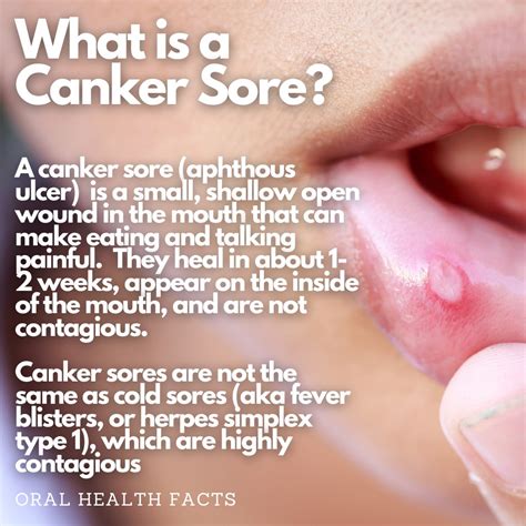 What Is A Canker Sore And Is It The Same As A Cold Sore A Canker
