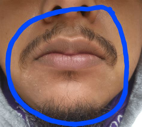 Flaky Skin Around Mouth Rskincareaddiction
