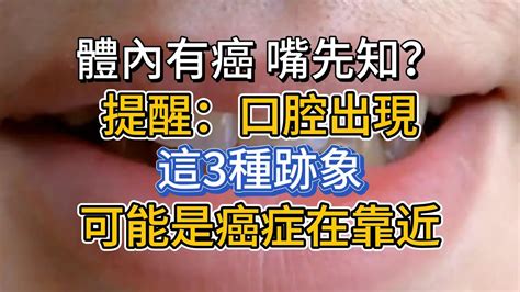 體內有癌，嘴先知？提醒：口腔出現這3種跡象，可能是癌症在靠近 Youtube