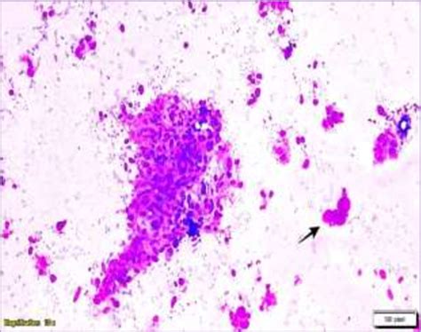 Cellular Cluster With Round To Oval Cells Occasional Cells Show Highly
