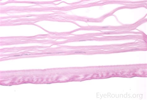 Bullous Keratopathy Histology