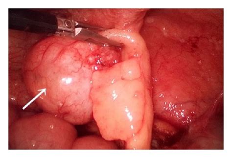Swelling At The Distal Part Of The Appendix White Arrow Laparoscopic Download Scientific