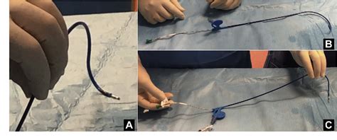 Left Bundle Branch Pacing By Standard Stylet Driven Lead Preliminary