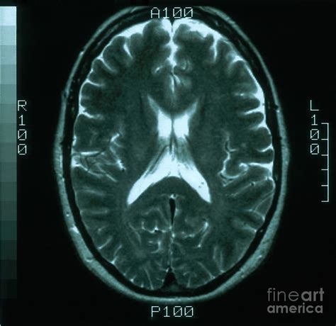 Female Normal MRI Brain