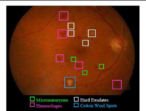 Figure 1 From Segmentation Of Exudates Via Color Based K Means