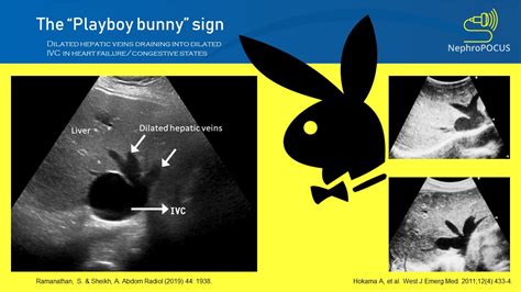 The Pocus Kingdom Nephropocus