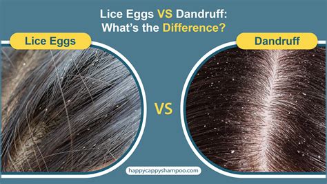 Lice Eggs Vs Dandruff Whats The Difference Happy Cappy