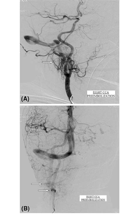 A Digital Subtraction Angiography Dsa Demonstrates Fistula Between