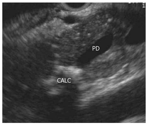 Pancreatic Divisum Ultrasound
