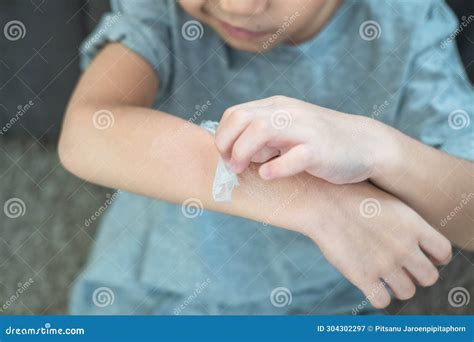 Los Niños Pequeños Asiáticos Tienen Las Manos Pelando Su Piel Seca En El Brazo Problemas De