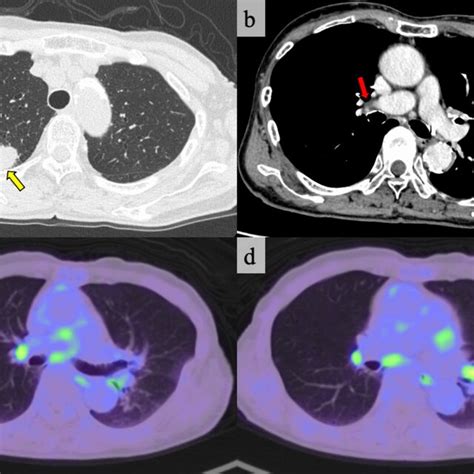 Preoperative Chest Computed Tomography Findings The Lung Tumor Is