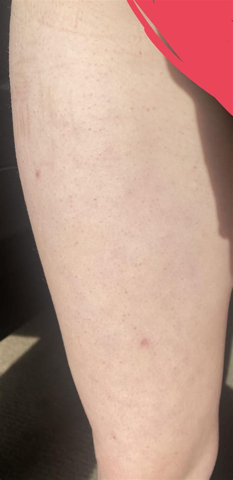 Teeny Tiny Bumps All Over Face What Do I Do Rrosacea