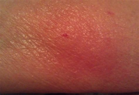Cockroach Cockroach Bite
