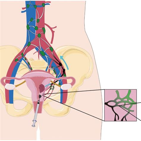 Distribution Pattern Of Pelvic And Abdominal Sentinel Lymph Nodes Download Scientific Diagram