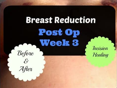 Breast Reduction Post Op Week Before After Pics Incision Healing