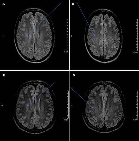 Brain Mri Abnormalities In Atl1 Patients Abnormal Signals Of White Download Scientific Diagram