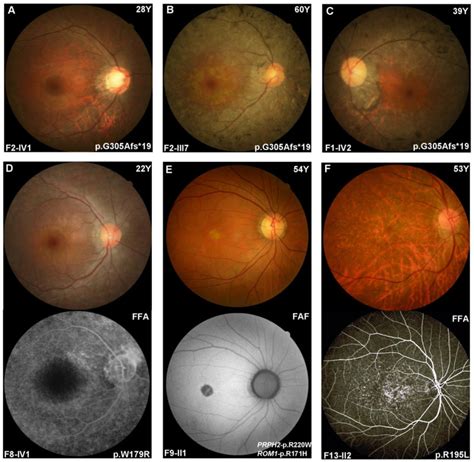 New Insight Into The Genotype Phenotype Correlation Of Prph2 Related Diseases Based On A Large