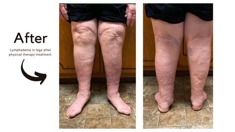 Lymphedema Dallas Pa Mobile Therapy Services