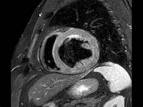 Cardiac Infarction With Compressed Sense Philips Mr Body Map