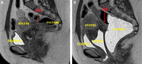 Mri Of The Pelvis Sagittal T2 Weighted Tse Sequence Without A And