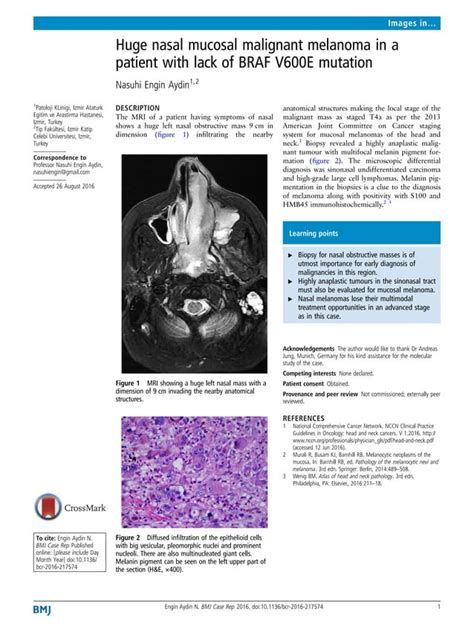 Nasal Melanoma Case Report Lacking Braf Mutation Pdf