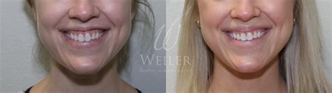 Botox® Cosmetic Before And After Pictures Case 1177 Baton Rouge New